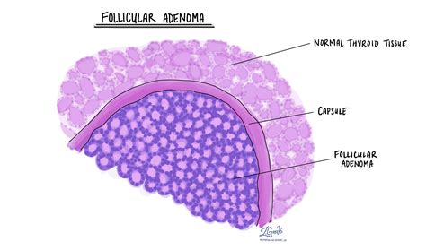 Follicular Thyroid Carcinoma Thyroid Gland Mypathologyreportca