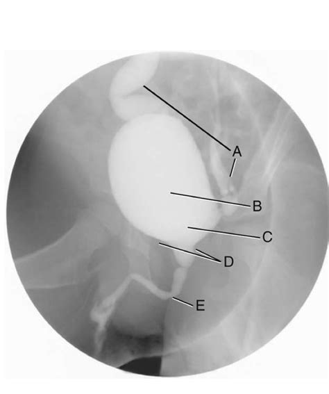 Voiding Cystourethrogram Diagram Quizlet