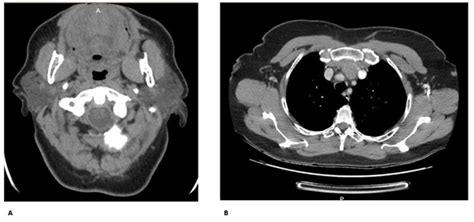 Plongeant Goiter Short Case Series Description Clinicsearch