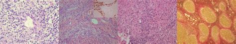 Easl Clinical Practice Guidelines The Diagnosis And Management Of
