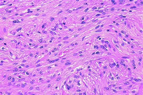 Neoplasm Spindle Cell Neoplasm Lung