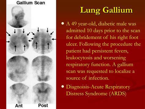 Ppt Gallium Imaging In Lymphomas And Inflammatory Disorders Powerpoint