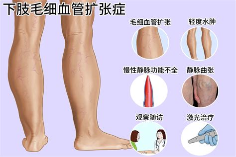 腿部毛细血管扩张症图片39健康网