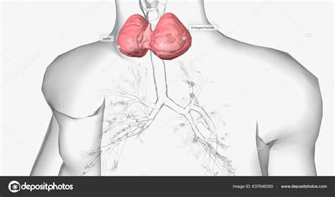 Goiter Swollen Rounded Lump Throat Caused Abnormal Enlargement Thyroid