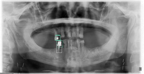 Deep Learning Object Detection On Dental X Rays Clement Joudet Blog