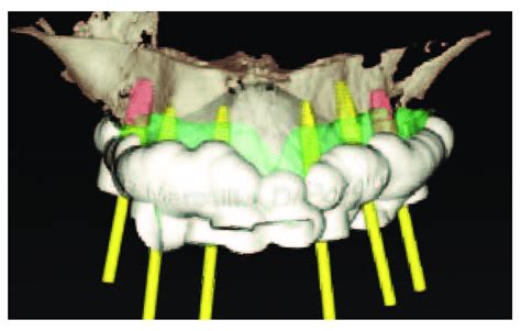Design Of The Surgical Guide Download Scientific Diagram