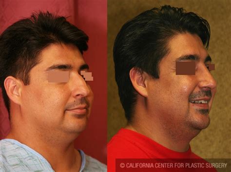 Patient 6413 Male Rhinoplasty Before And After Photos Beverly Hills