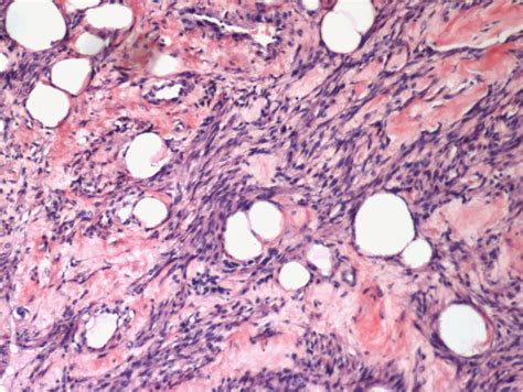 Benigni Benign Cervical Lesions