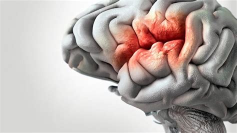 Accidente Cerebrovascular Acv Causas Síntomas Y Tratamientos