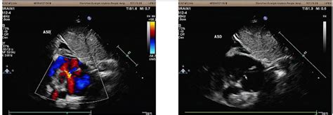 Image Of Color Doppler Echocardiography Download Scientific Diagram