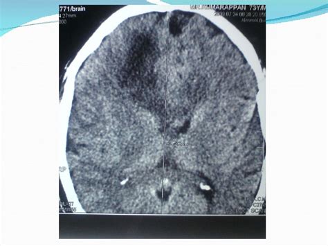 Ct Scan Glioblastoma Multiforme