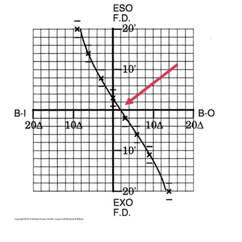 Vergence Disorders Treatment 1 And 2 And 3 Flashcards Quizlet