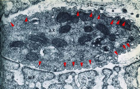 Electron Microscopy Analysis Of Neuromuscular Junction Of Phrenic