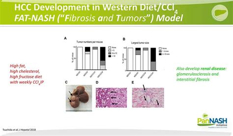Hcc Pathogenesis In Nash And The Impact Of Fibrosis Pannash