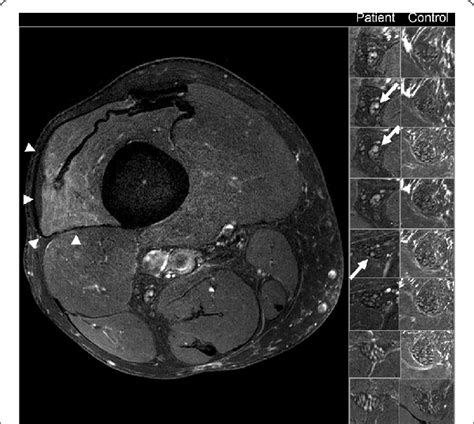 Mr Neurography High Resolution T2 Spair Of The Ischiadic Nerve