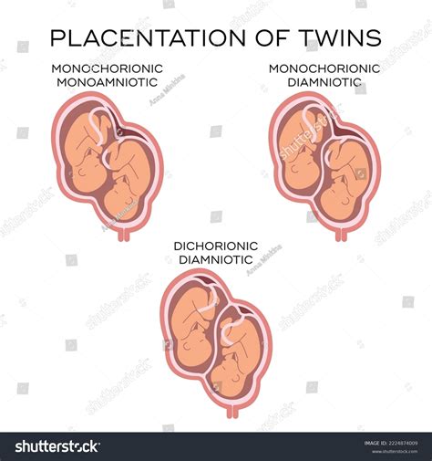 Placentation Twins Flat Vector Illustration Multiple Stock Vector