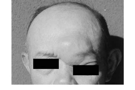 Photograph Illustrating The Huge Cholesterol Granuloma Of The Frontal