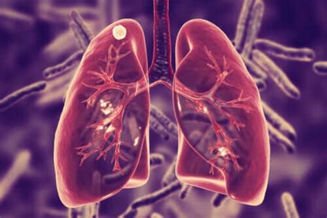 What Is Pulmonary Tuberculosis And What Are Its Symptoms Step To Health