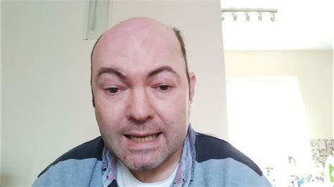 My Epilipsy Story Youtube