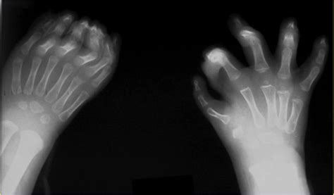 Tibial Hemimelia Buyxraysonline