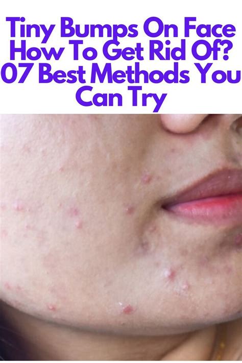 Tiny Bumps On Face How To Get Rid Of 07 Best Methods You Can Try Dark
