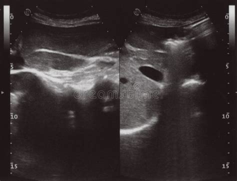 Full Abdomen Ultrasound Sonogram Stock Image Image Of Healthcare