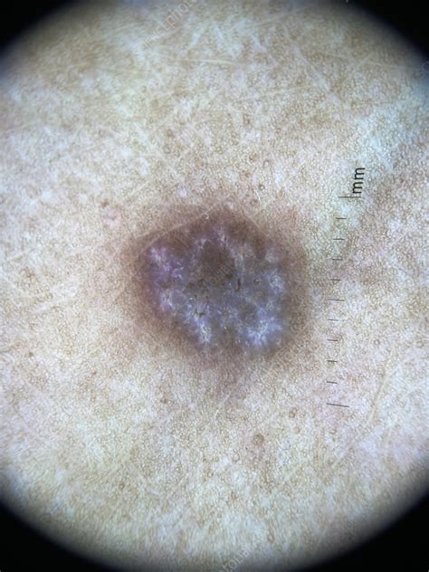 Hypertrophic Lichen Planus Dermoscopy Stock Image C0572122