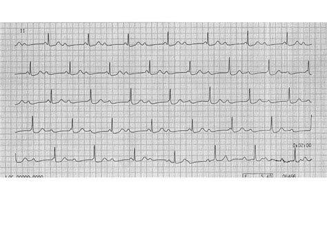 Ecg Lecture Sinus Arrest Sinoatrial Exit Block Av Block And Escape