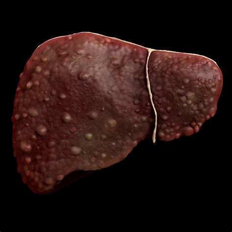 Cirrhosis Of The Liver Vs Healthy Liver