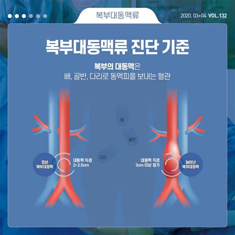 수술 잘하는 병원 복부대동맥류 스텐트 도관으로 국소마취 치료 네이버 포스트