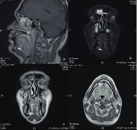 A Sag T1 Fse B Coronal Short Tau Inversion Recovery C Contrast