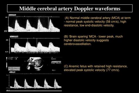 Middle Cerebral Artery Doppler