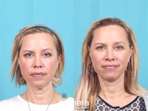 Mini Facelift Before And After Pictures Case 664 Orlando Winter Park And Tampa Florida