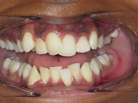 Crooked Overcrowded Teeth Teeth In Line