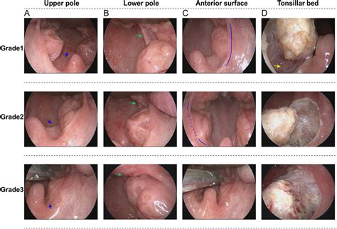 Classification And Grading Of Tonsil Anatomy A Upper Pole The