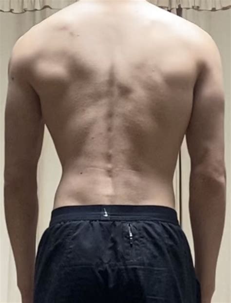 안녕하세요 척추측만증으로 인한 광배근 비대칭 어떻게 해결해야 할까요 몬스터짐