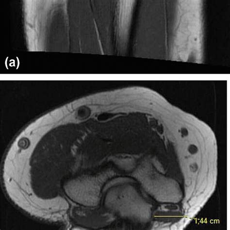 Measurement Of Craniocaudal A Transverse B Anteroposterior C In Download Scientific