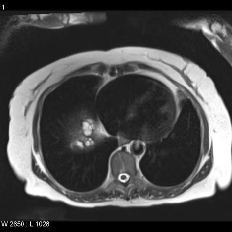 There Is A Large Fluid Filled Cysts Within The Liver Containing