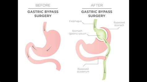 Dr Shanker Pasupathy On Weight Losstreatment Youtube