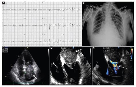 High Grade Undifferentiated Pleomorphic Cardiac Sarcoma A Rare Malignant Primary Cardiac Tumor