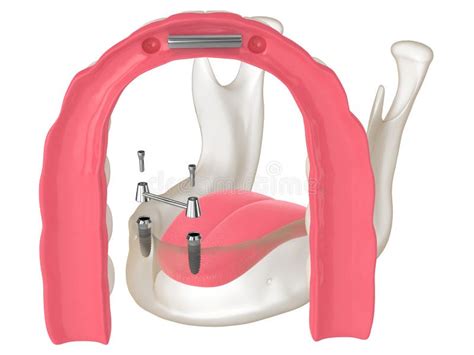 3d Render Of Removable Overdenture Installation On Bar Clip Attachment