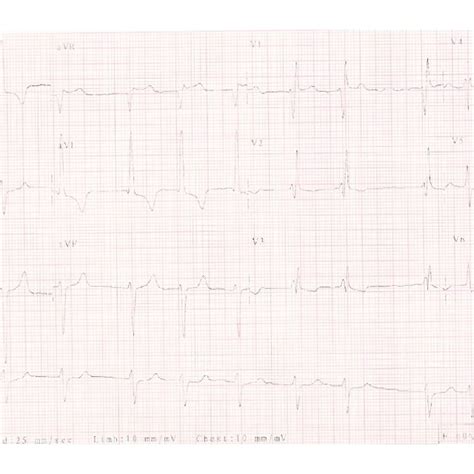 Electrocardiogram Sinus Rhythm Left Bundle Branch Block And Of Its Download Scientific