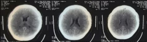 Cranial Ct Scan Normal Download Scientific Diagram