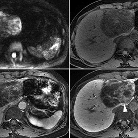 Appearence Of A Polypoid Mass Originating From The Left Perineum Of The