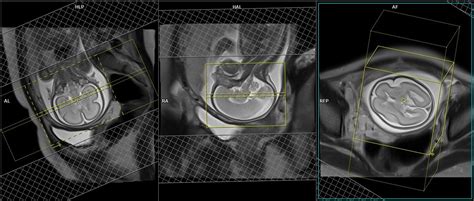 Fetal Brain Mri Fetal Brain Scan Protocol And Planning