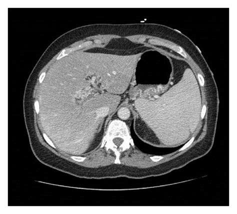 Ct Demonstrated Periportal Collateral Circulation And Gastric Varices