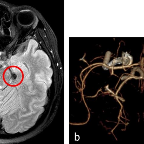 A The Patients Flair Sequence Of Brain Mri A Saccular Flow Void Is Download Scientific