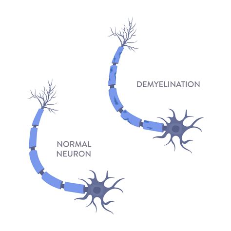 Demyelination Symptoms Causes Diagnosis Treatment