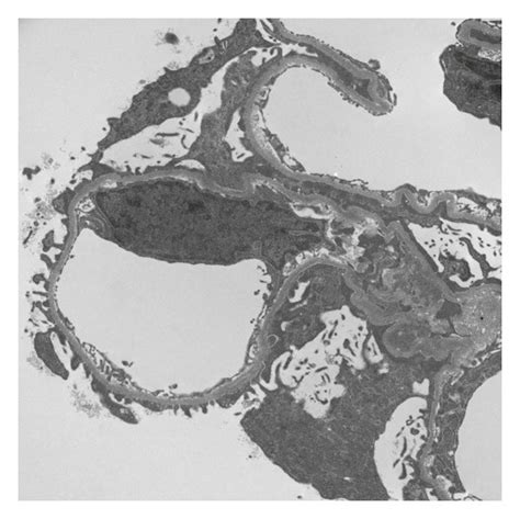 Light Microscopy And Ultrastructural Features A Glomerulus Showing A
