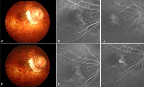 A 37 Year Old Woman Visited Our Clinic With Decreased Visual Acuity In
